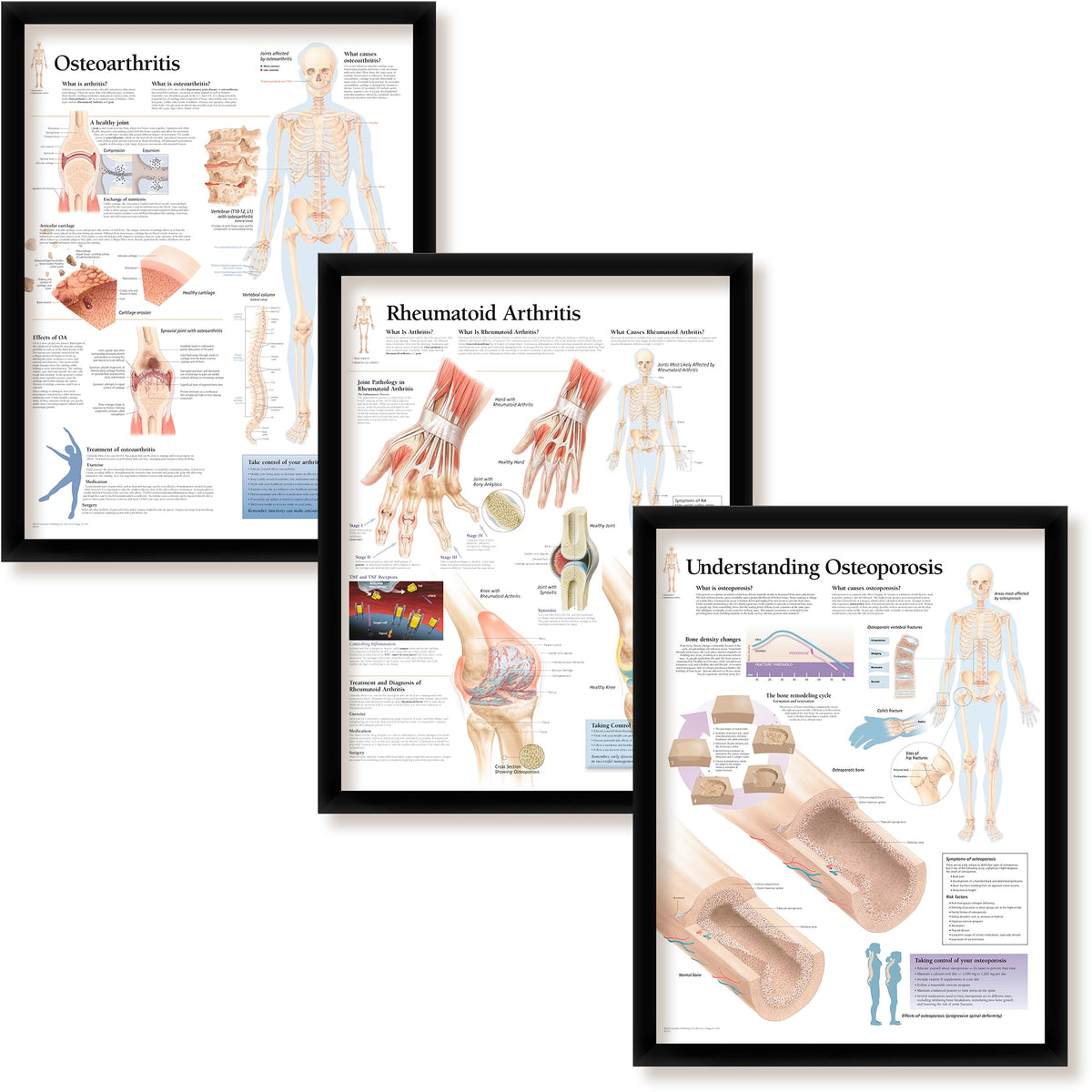Set of 3 Framed Medical Posters Osteoarthritis Rheumatoid Arthritis Un ...