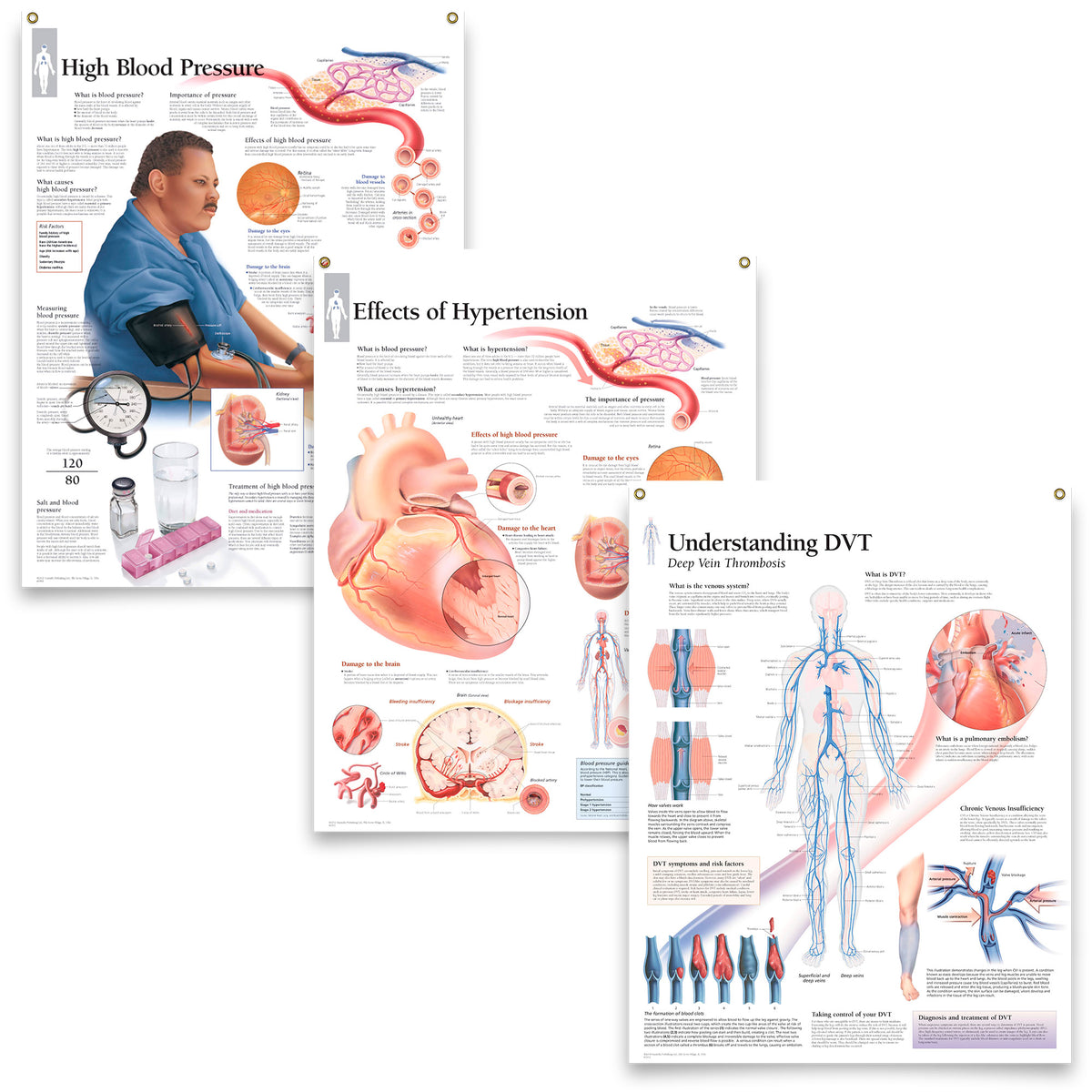 Hypertension Causes Poster