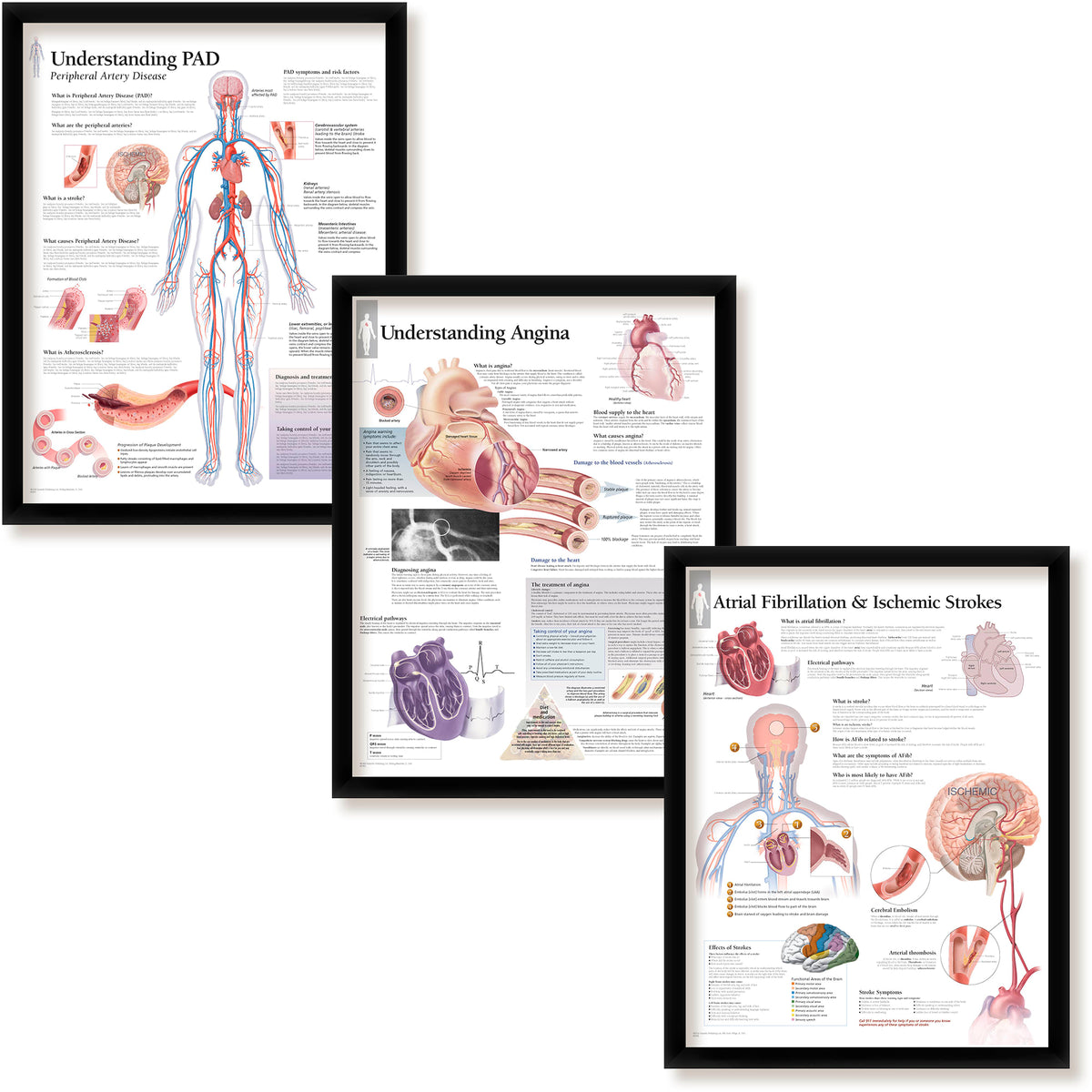 Set of 3 Framed Medical Posters Understanding PAD Understanding Angina ...