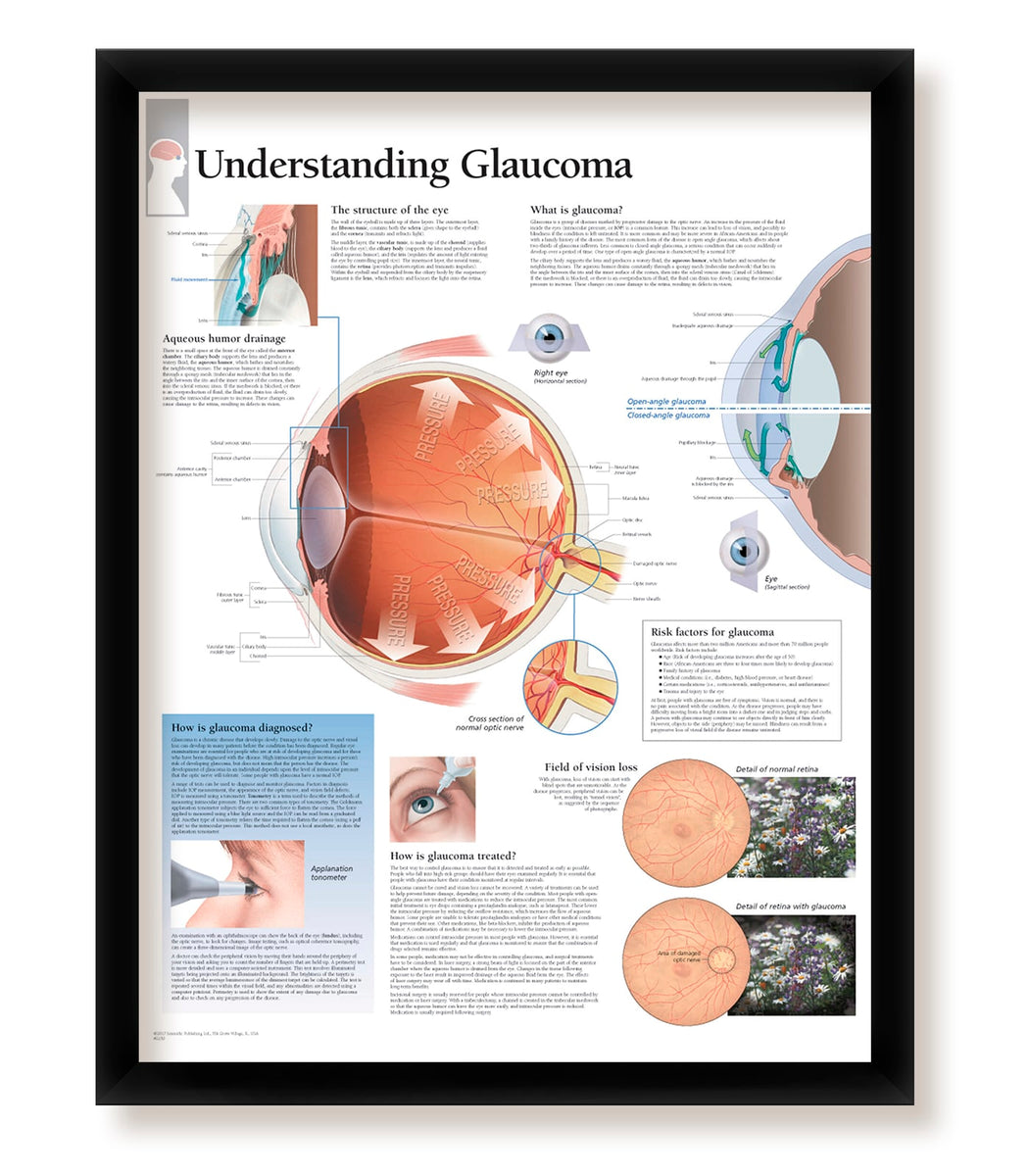 Set of 2 Framed Medical Posters The Eye and Understanding Glaucoma 22 ...